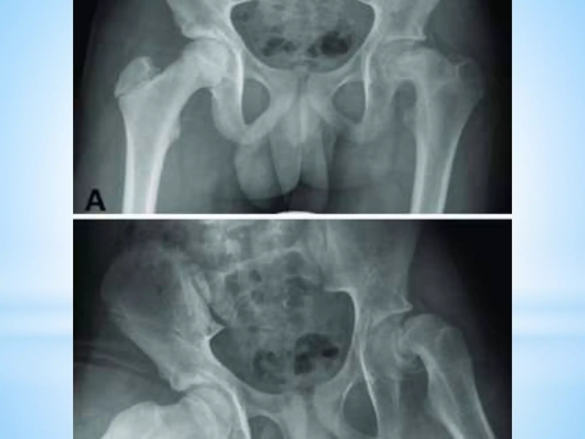 Slipped caital femroal epiphysis (scfe) | PPTX