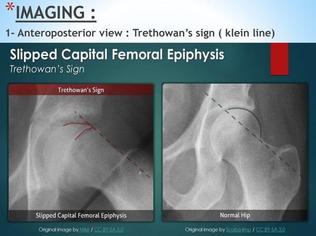 Slipped caital femroal epiphysis (scfe) | PPT