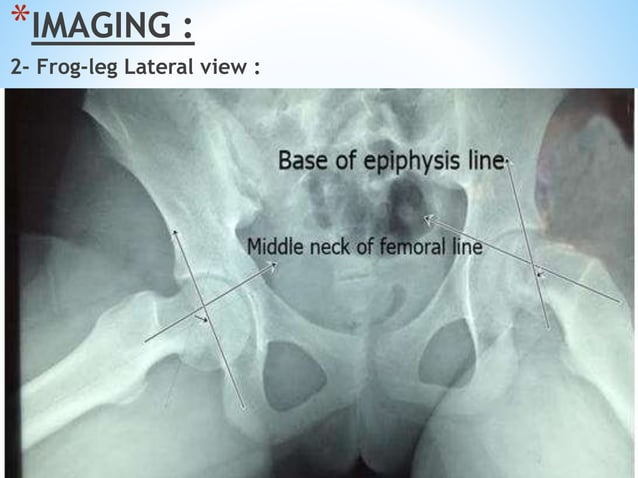 Slipped caital femroal epiphysis (scfe) | PPT