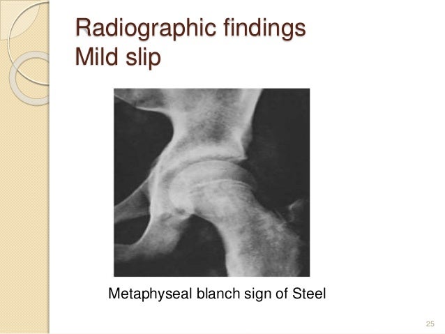 Slipped capital epiphysis