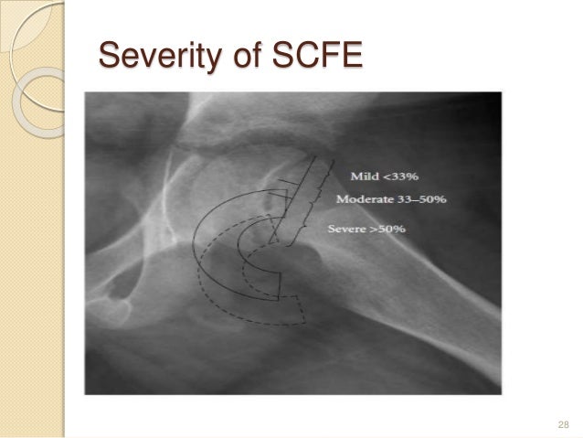 Slipped capital epiphysis