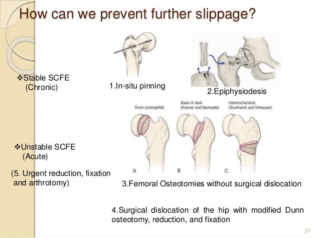 Slipped capital epiphysis