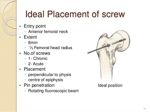 Slipped capital epiphysis