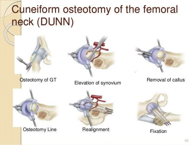 Slipped capital epiphysis