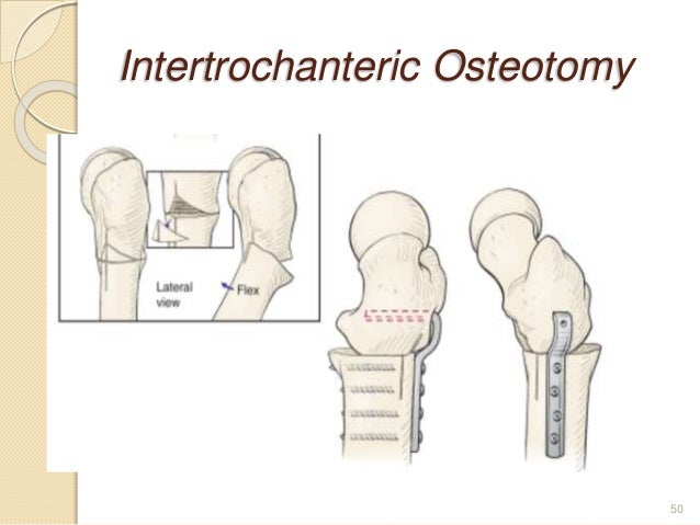 Slipped capital epiphysis