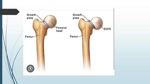 Slipped capital femoral epiphysis .pptx