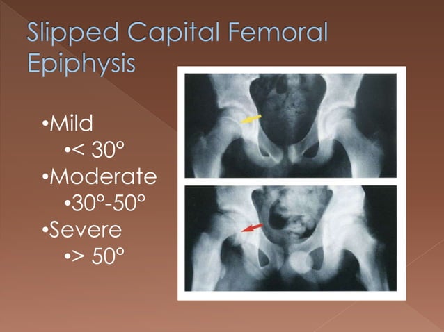 Slipped capital femoral epiphysis | PPT