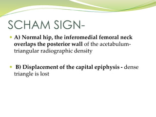Slipped capital femoral epiphysis | PPTX