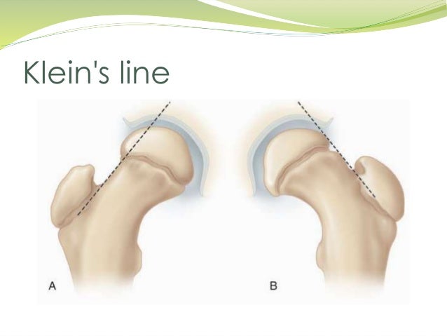 Slipped capital femoral epiphysis