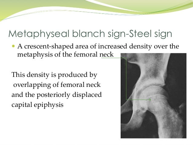 Slipped capital femoral epiphysis
