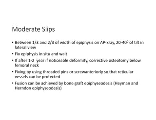 Slipped capital femoral epiphysis | PDF