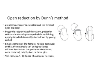 Slipped capital femoral epiphysis | PDF