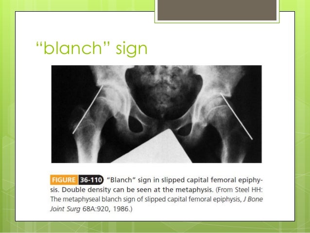 Slipped capital femoral epiphysis