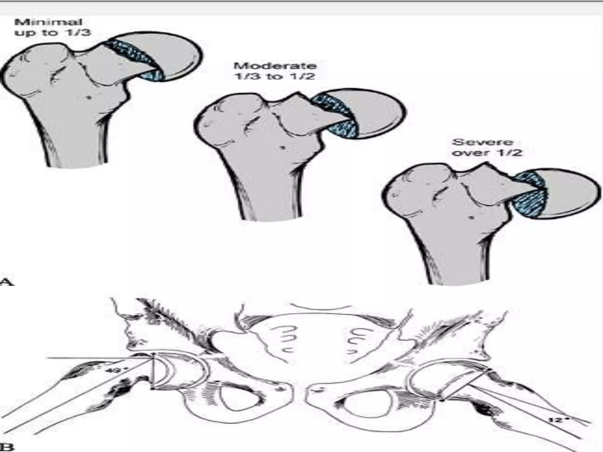 Slipped capital femoral epiphysis | PPTX