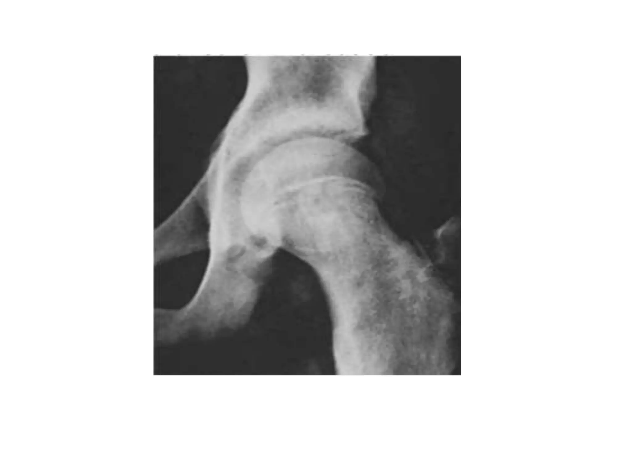 Slipped capital femoral epiphysis | PPTX | Bone and Joint Conditions ...