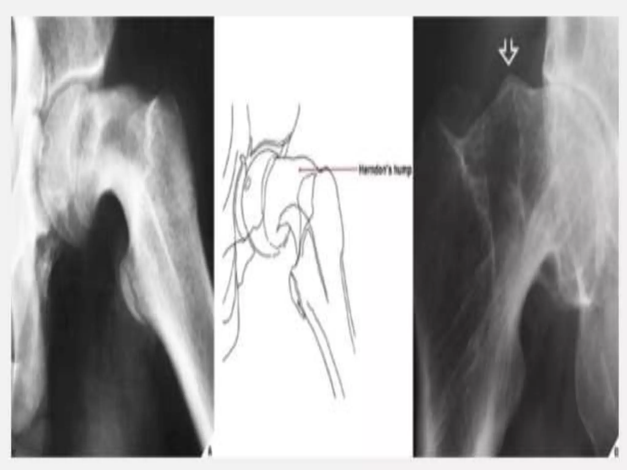 Slipped capital femoral epiphysis | PPTX | Bone and Joint Conditions ...