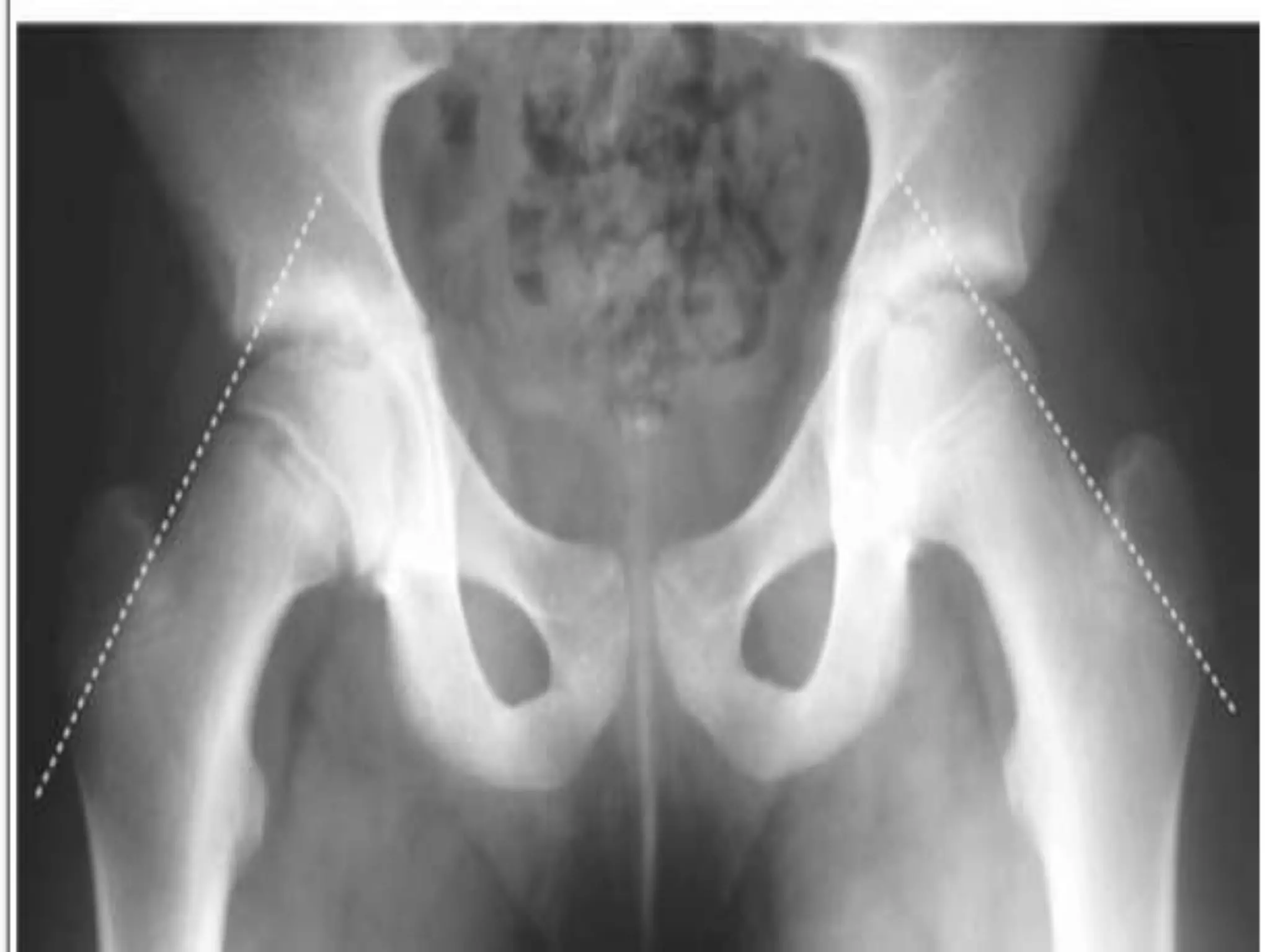 Slipped capital femoral epiphysis | PPTX | Bone and Joint Conditions ...