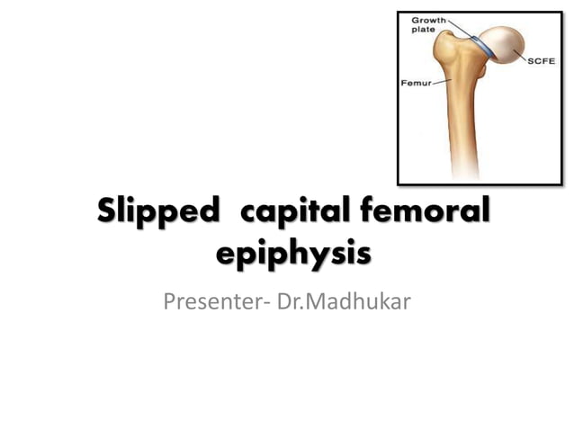 Slipped capital femoral epiphysis | PPTX | Bone and Joint Conditions ...