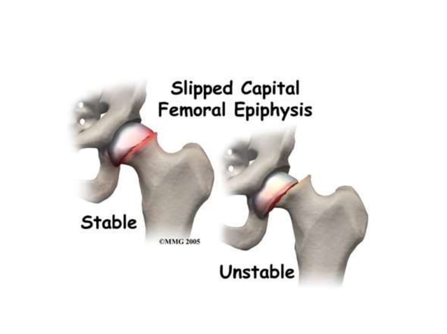 Slipped capital femoral epiphysis | PPTX | Bone and Joint Conditions ...