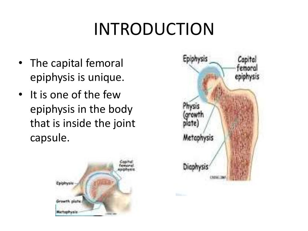 Slipped capital femoral epiphysis