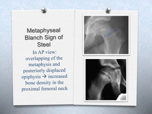 Slipped capital femoral epiphysis | PPTX