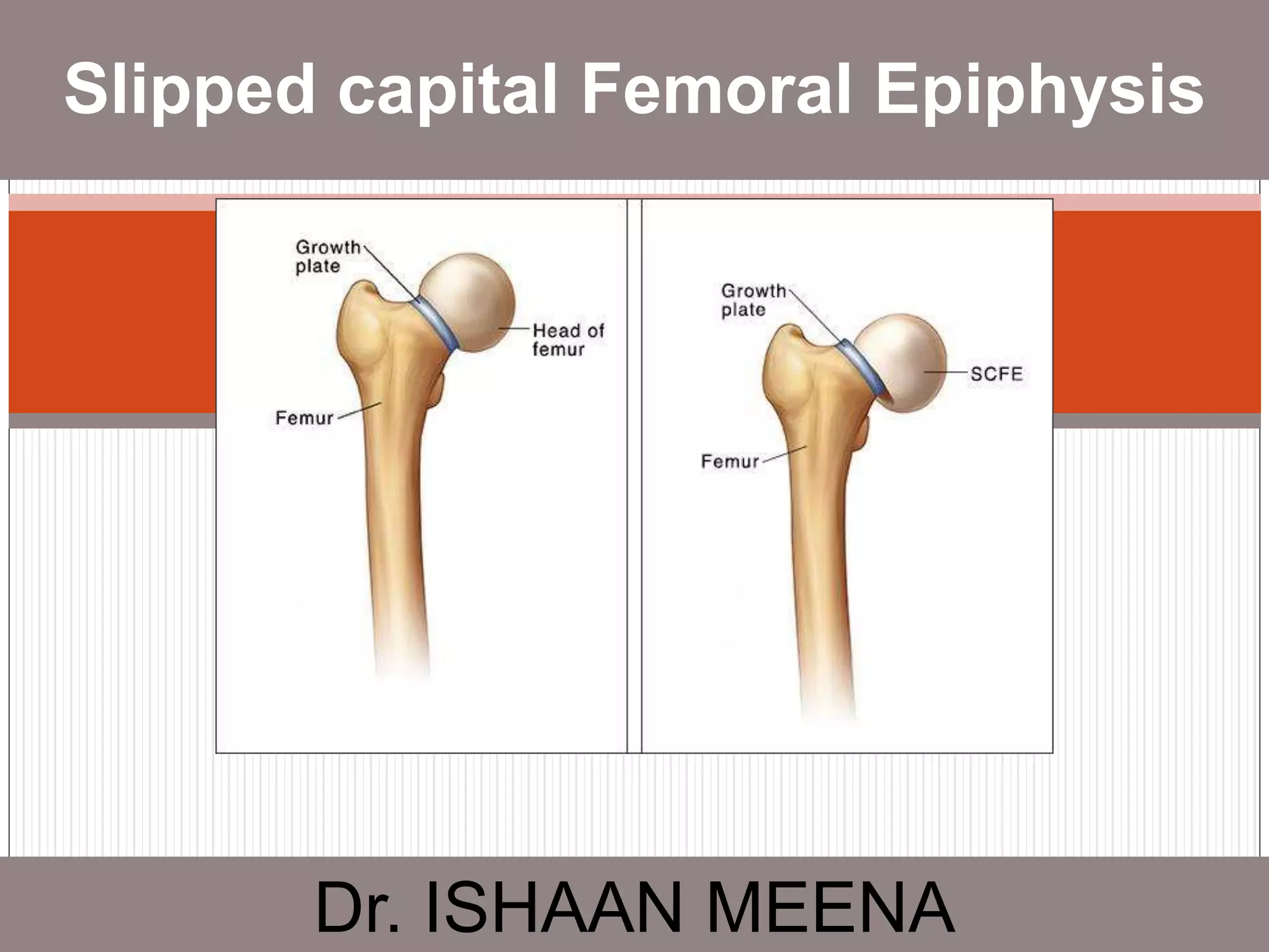 Slipped capital femoral epiphysis | PPTX