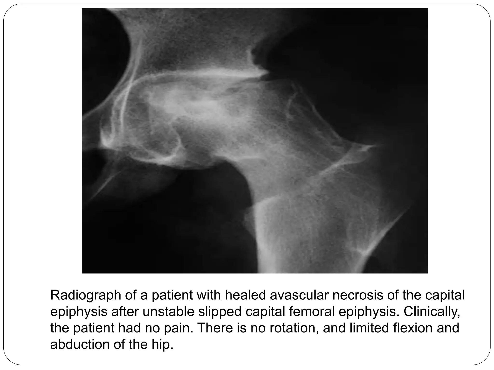 Slipped capital femoral epiphysis | PPTX