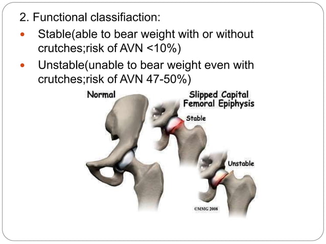Slipped capital femoral epiphysis | PPTX