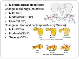 Slipped capital femoral epiphysis | PPTX