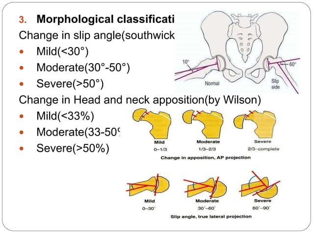 Slipped capital femoral epiphysis | PPTX