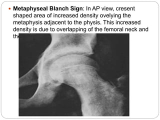 Slipped capital femoral epiphysis | PPTX