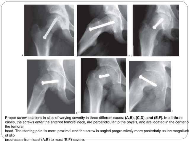 Slipped capital femoral epiphysis | PPTX