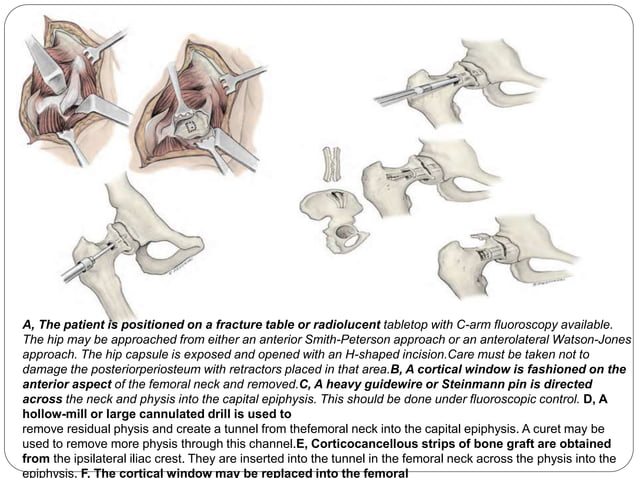 Slipped capital femoral epiphysis | PPTX