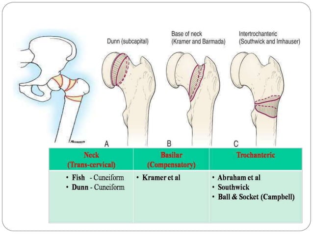 Slipped capital femoral epiphysis | PPTX