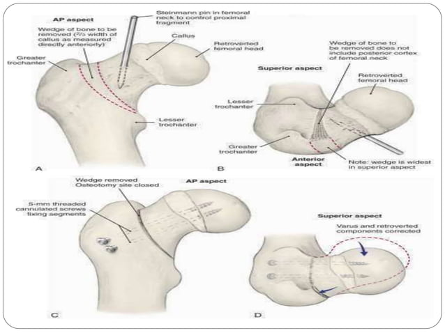 Slipped capital femoral epiphysis | PPTX