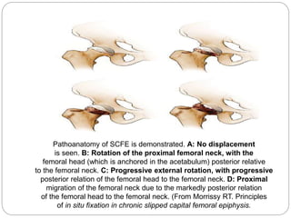 Slipped capital femoral epiphysis | PPTX
