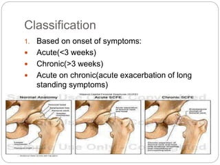 Slipped capital femoral epiphysis | PPTX