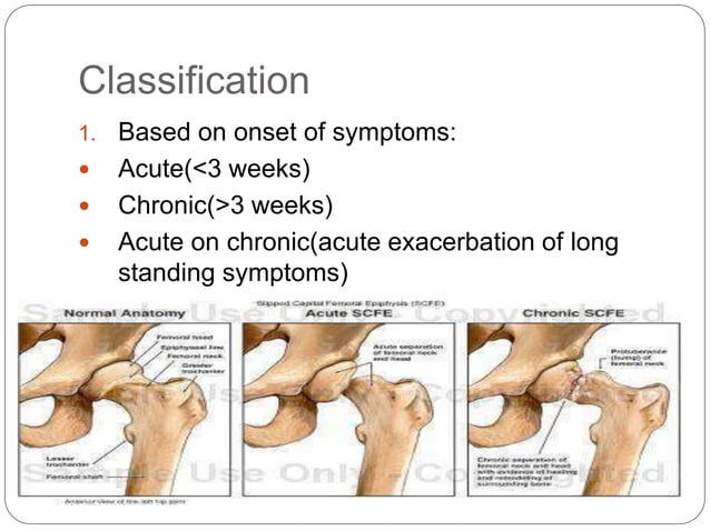Slipped capital femoral epiphysis | PPTX