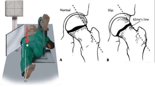 SLIPPED CAPITAL FEMORAL EPIPHYSIS.(SUFE) | PPTX