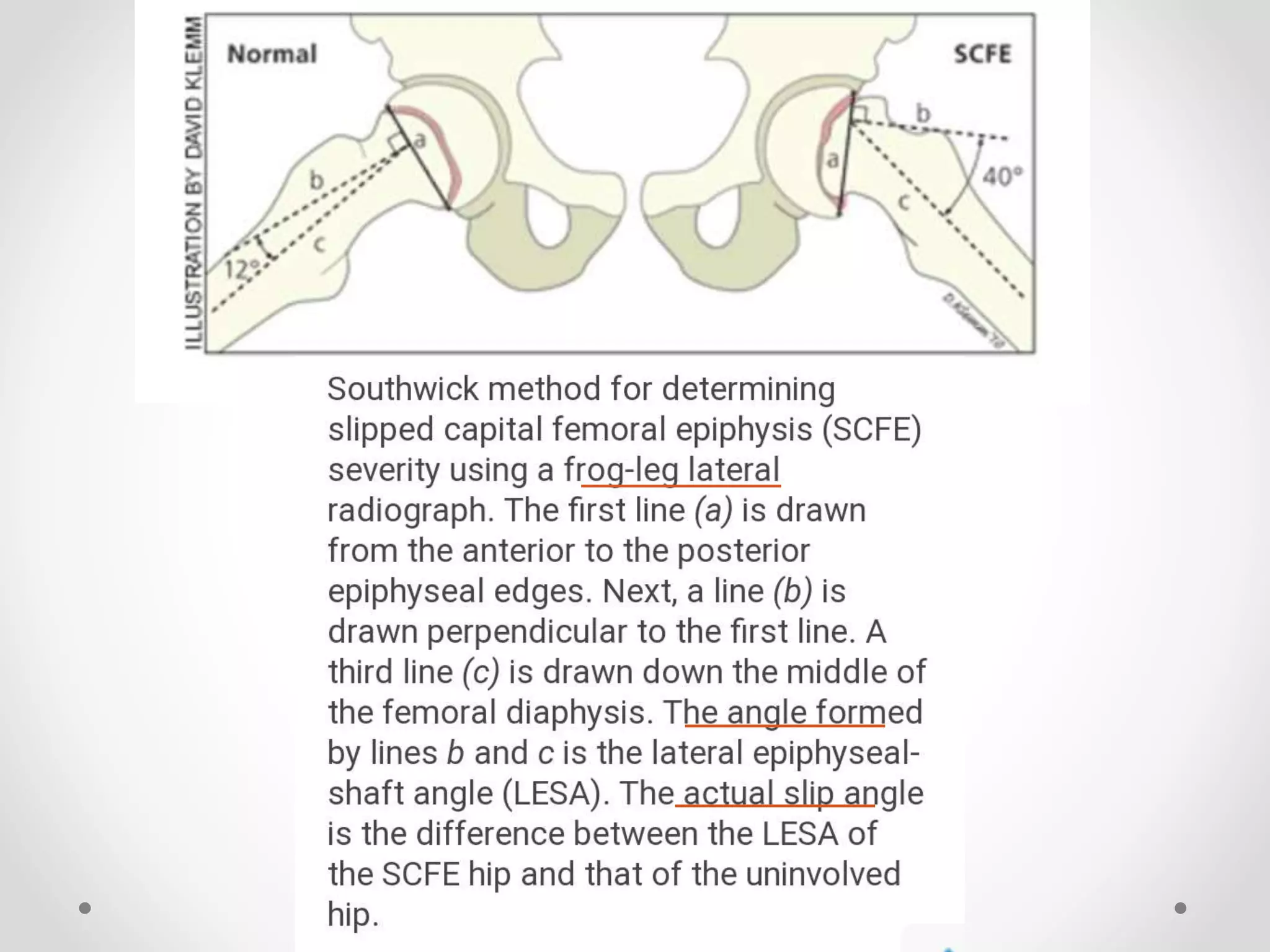 Slipped capital femoral epiphysis (scfe) | PPTX | Death, Injury, or ...