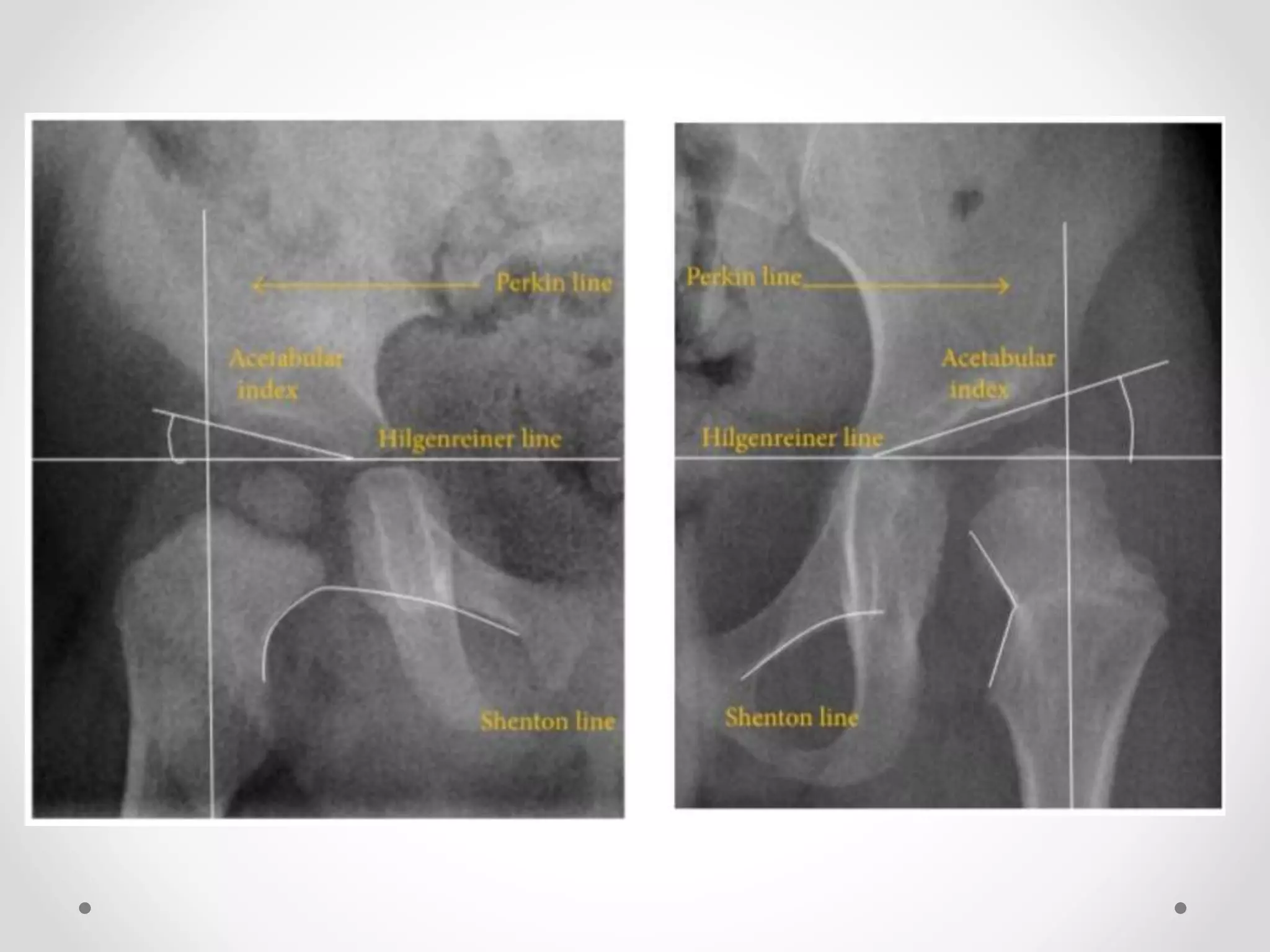 Slipped capital femoral epiphysis (scfe) | PPTX