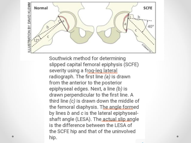 Slipped capital femoral epiphysis (scfe) | PPTX | Death, Injury, or ...
