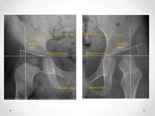 Slipped capital femoral epiphysis (scfe) | PPTX