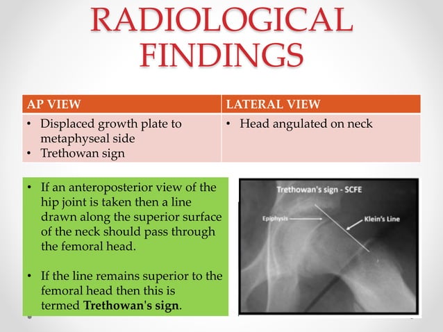 Slipped capital femoral epiphysis (scfe) | PPTX | Death, Injury, or ...