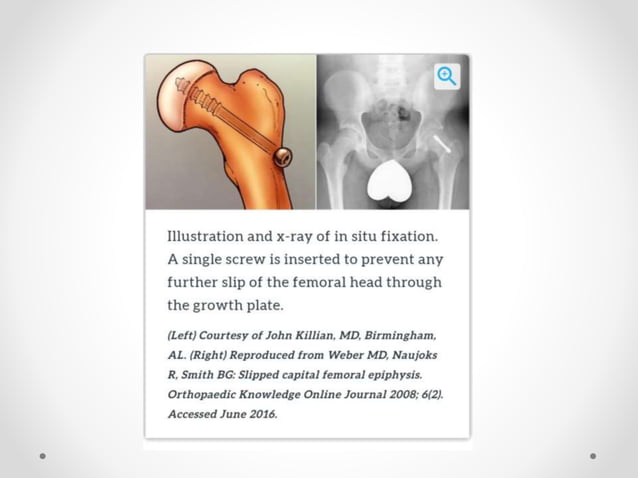 Slipped capital femoral epiphysis (scfe) | PPTX | Death, Injury, or ...