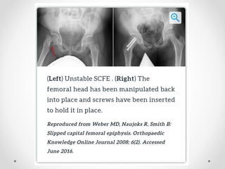 Slipped capital femoral epiphysis (scfe) | PPTX