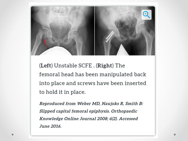 Slipped capital femoral epiphysis (scfe) | PPTX | Death, Injury, or ...