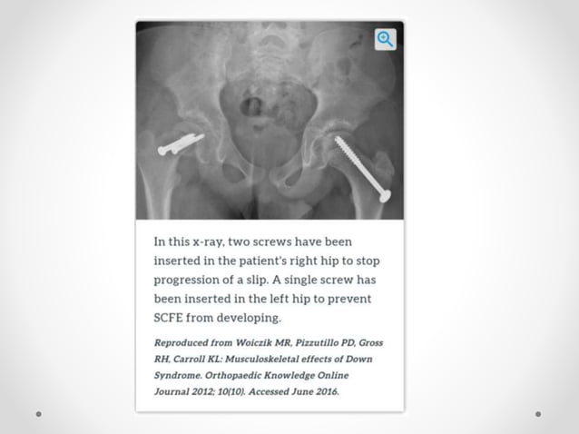 Slipped capital femoral epiphysis (scfe) | PPTX | Death, Injury, or ...