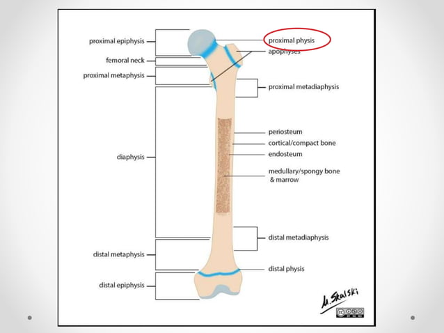 Slipped capital femoral epiphysis (scfe) | PPTX | Death, Injury, or ...