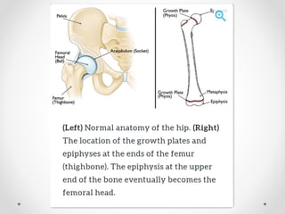 Slipped capital femoral epiphysis (scfe) | PPTX